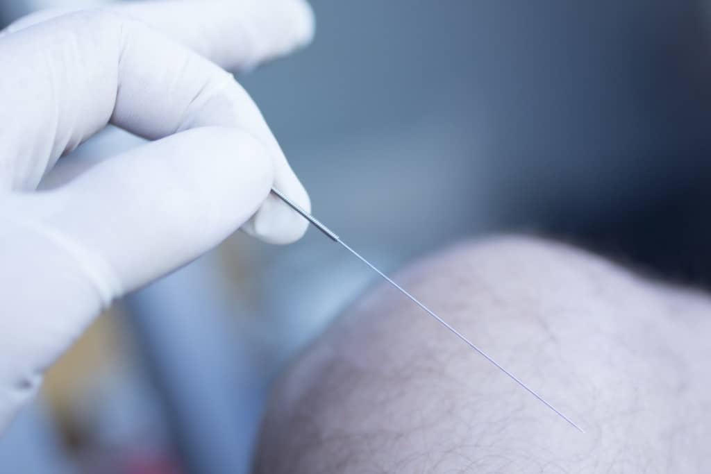 What Are the Risks and Adverse Effects from Dry Needling?